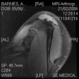 SC-AX | MRI scan of a SLAP lesion in my right shoulder follo… | Flickr